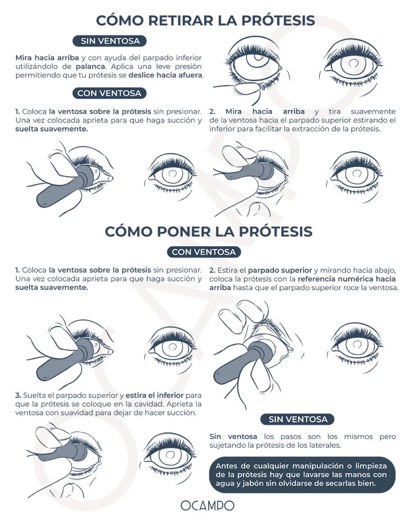 Cómo retirar y poner la prótesis ocular: Infografía Ocampo - Ocampo