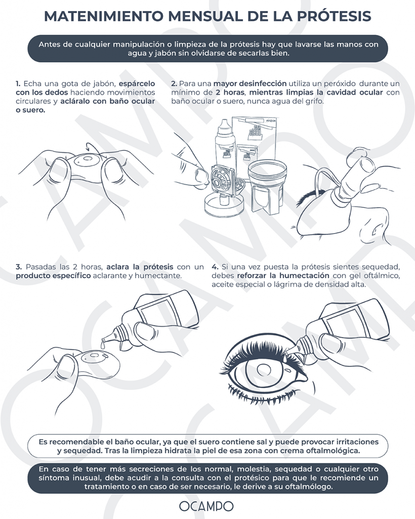 Mantenimiento mensual de la prótesis ocular: Infografía Ocampo – Ocampo